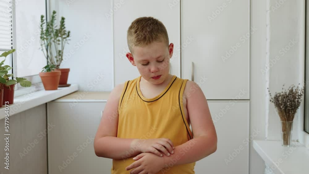 Frustrated school age boy examines reddened hands with sunburn. Sore ...