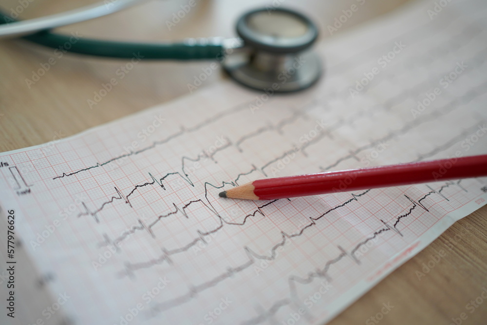 Pointing on a singular ventricular extrasystole (VES) on a ecg. Stock ...