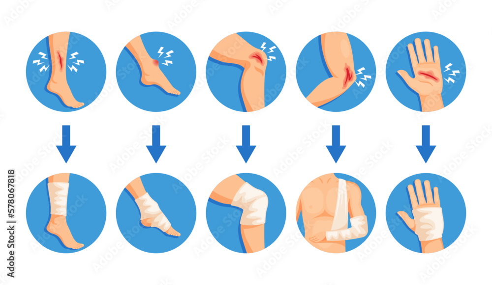 Hand And Leg Bandaging Process, Wrapping Bandages Around An Injured ...