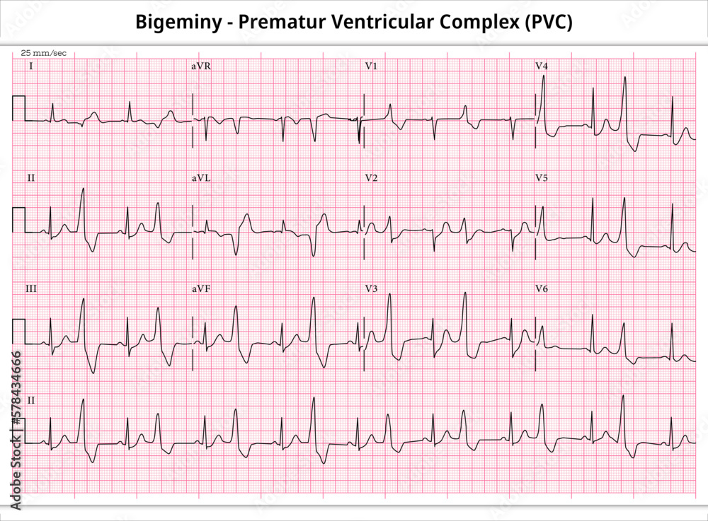 Bigeminy - Premature Ventricular Complex (PVC) - Ventricular Premature ...