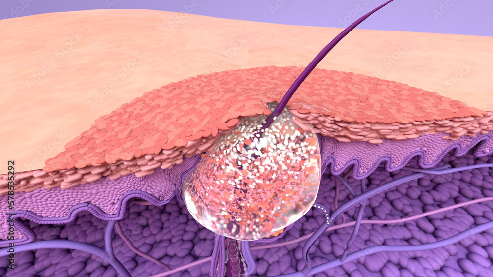 Formation of skin acne or pimple. The sebum in the clogged pore ...