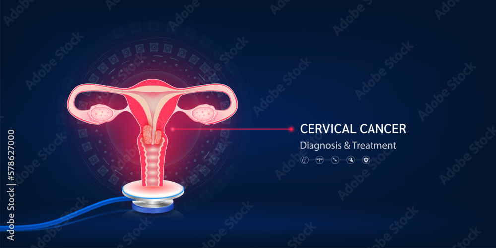 Cervical cancer disease. Female uterus anatomy model float away from ...