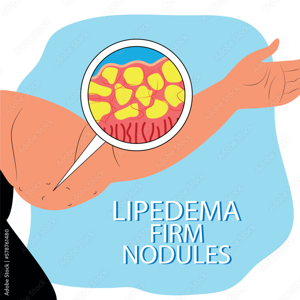 Lipedema firm nodules closeup. Fat woman's lipedema arm Stock Vector ...