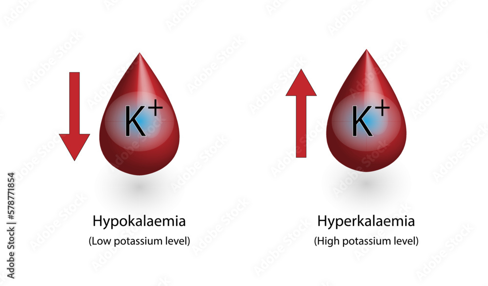 Hyperkalaemia, high plasma potassium level and Hypokalaemia, low plasma ...