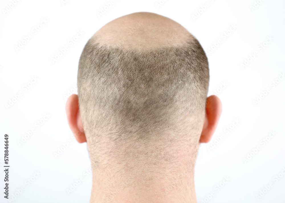 Bald man, rear view. Baldness close-up. Loss of hair on the head. Bald ...