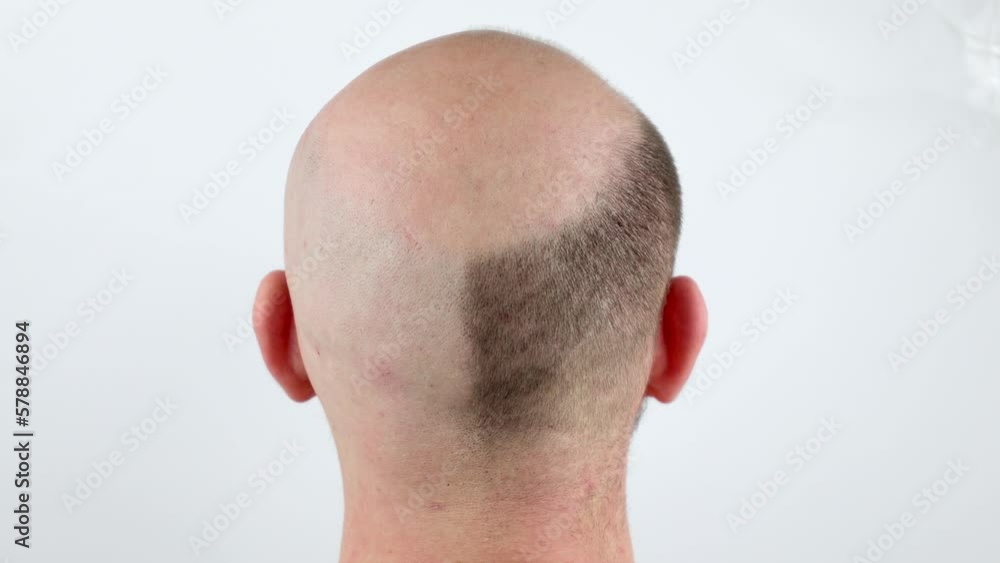 Bald man, rear view. Baldness close-up. Loss of hair on the head. Bald ...
