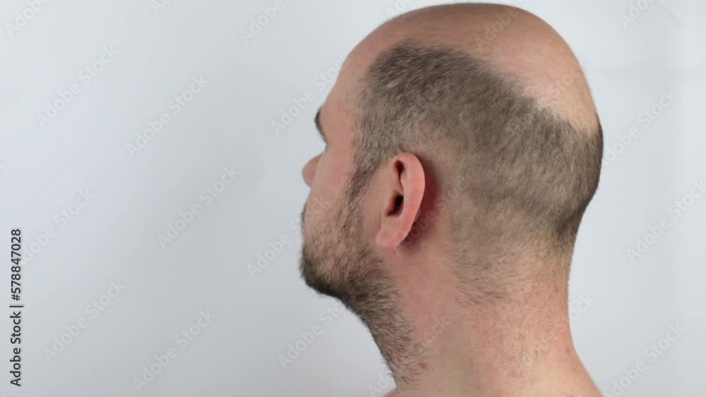 Vidéo Stock Bald man, rear view. Baldness close-up. Loss of hair on the ...