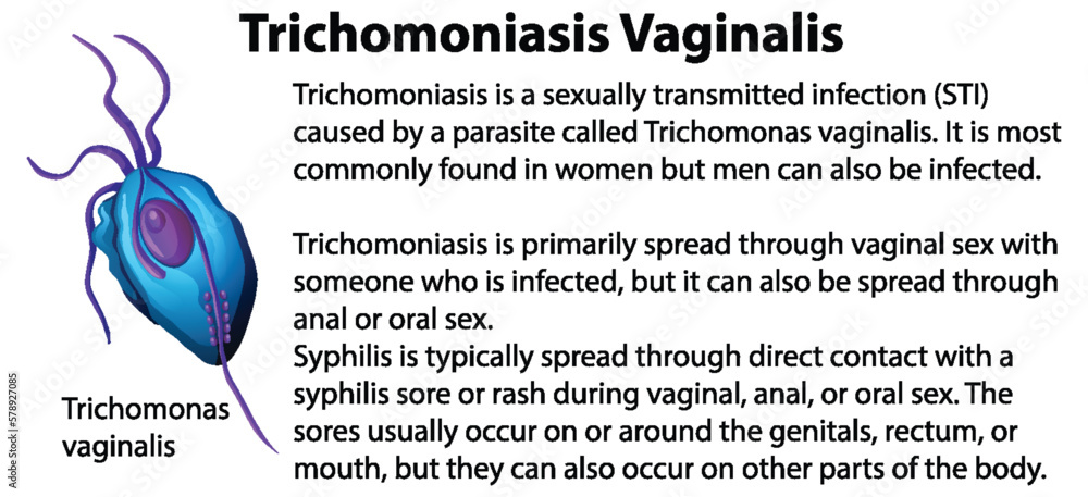 Trichomoniasis Vaginalis with explanation Stock Vector | Adobe Stock
