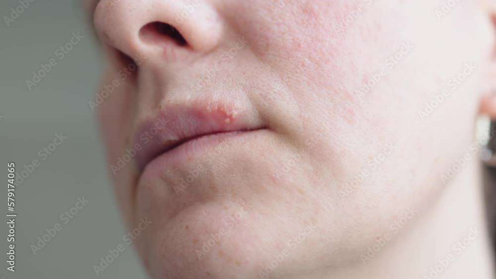 herpes simplex on female upper lip. woman suffering from herpes sore ...