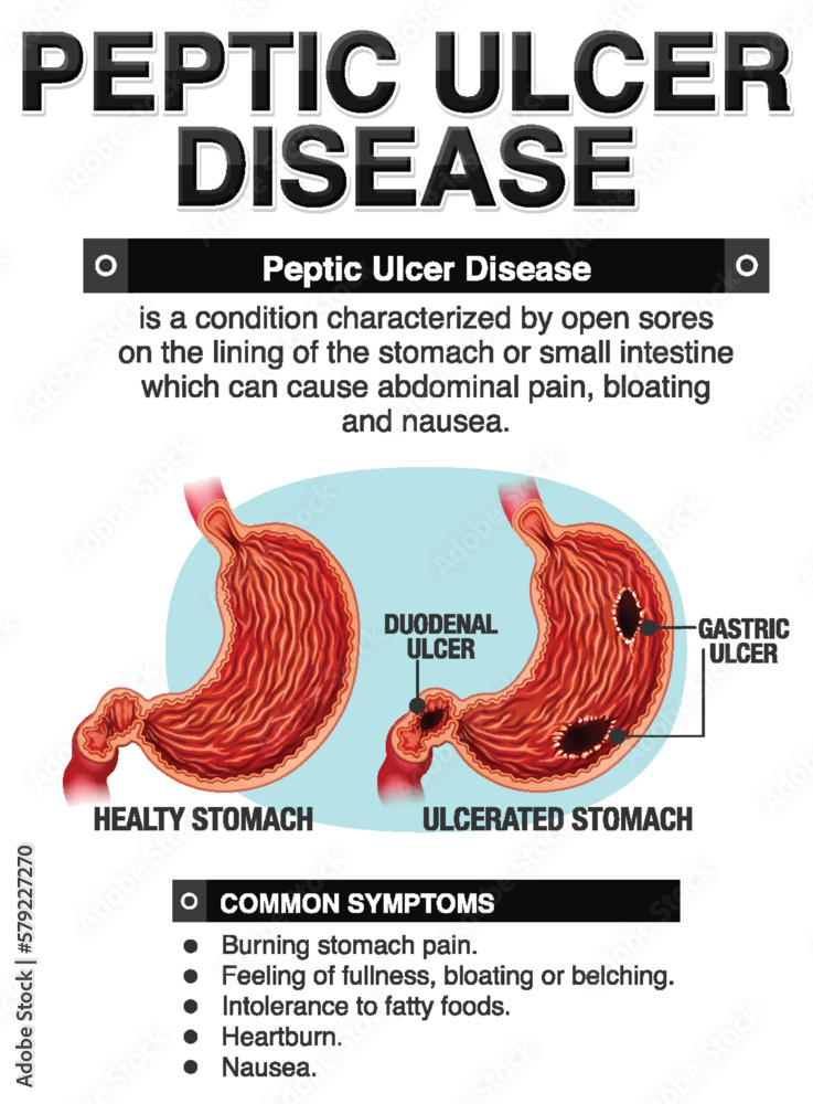 Poster Peptic Ulcer Disease Infographic – Wall Art | UkPosters