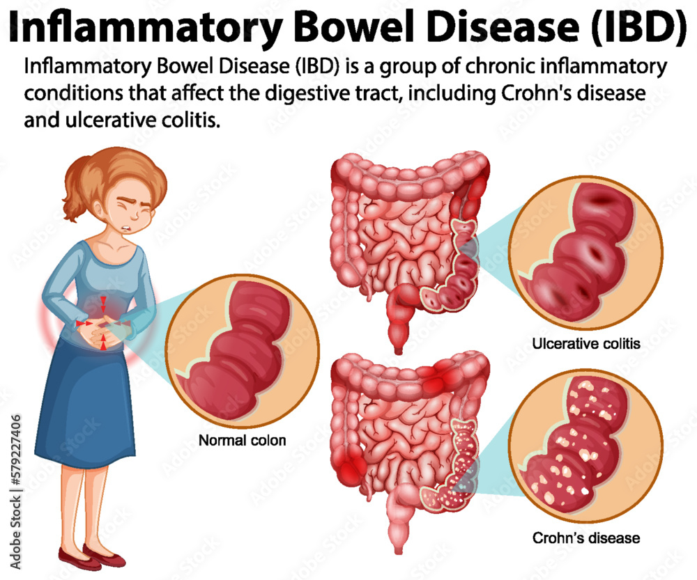 Inflammatory Bowel Disease (IBD) Infographic Stock Vector | Adobe Stock