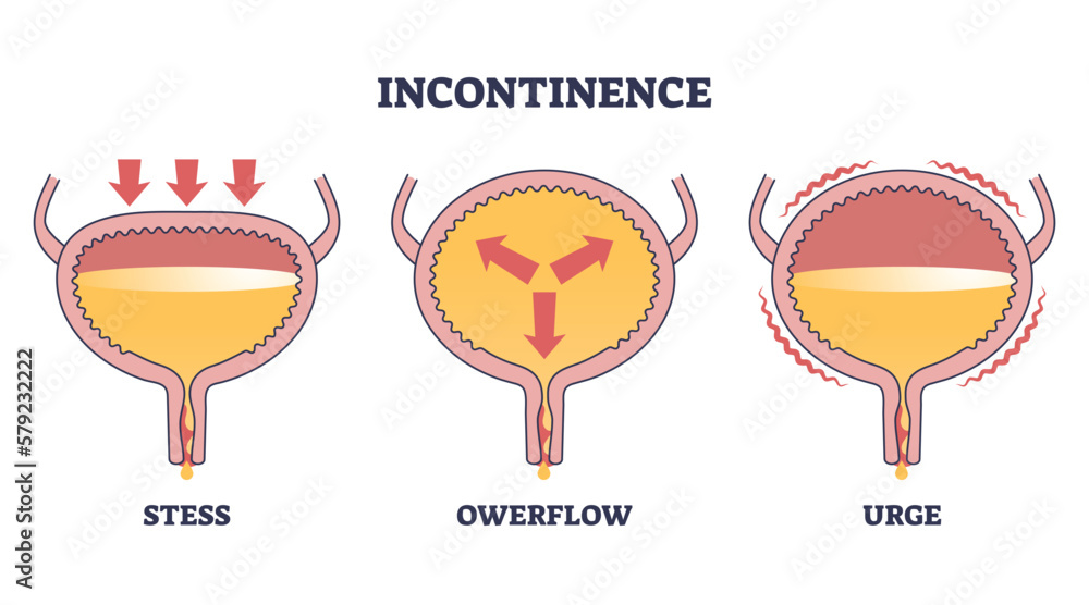 Incontinence Problem With Stress Owerflow And Urge Types Outline Diagram Labeled Educational