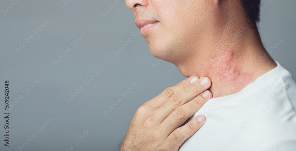 Man having red papules, itchy rash and scratching his neck. Skin ...