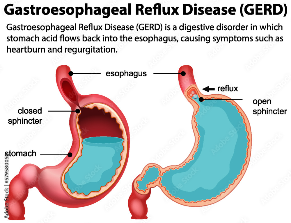 Photo Gastroesophageal Reflux Disease (GERD) Diagram | Posters ...