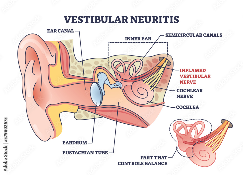 Vestibular neuritis as inner ear nerve inflammation disease outline diagram. Labeled educational ...
