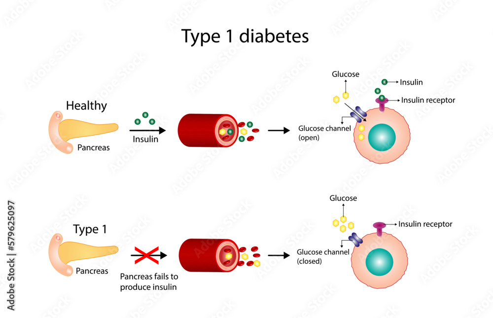 Diabetes Mellitus Type 1 Pancreas s Failure To Produce Enough Insulin