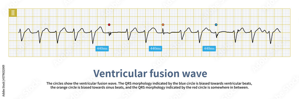 During ventricular tachycardia, supraventricular beats can form ...