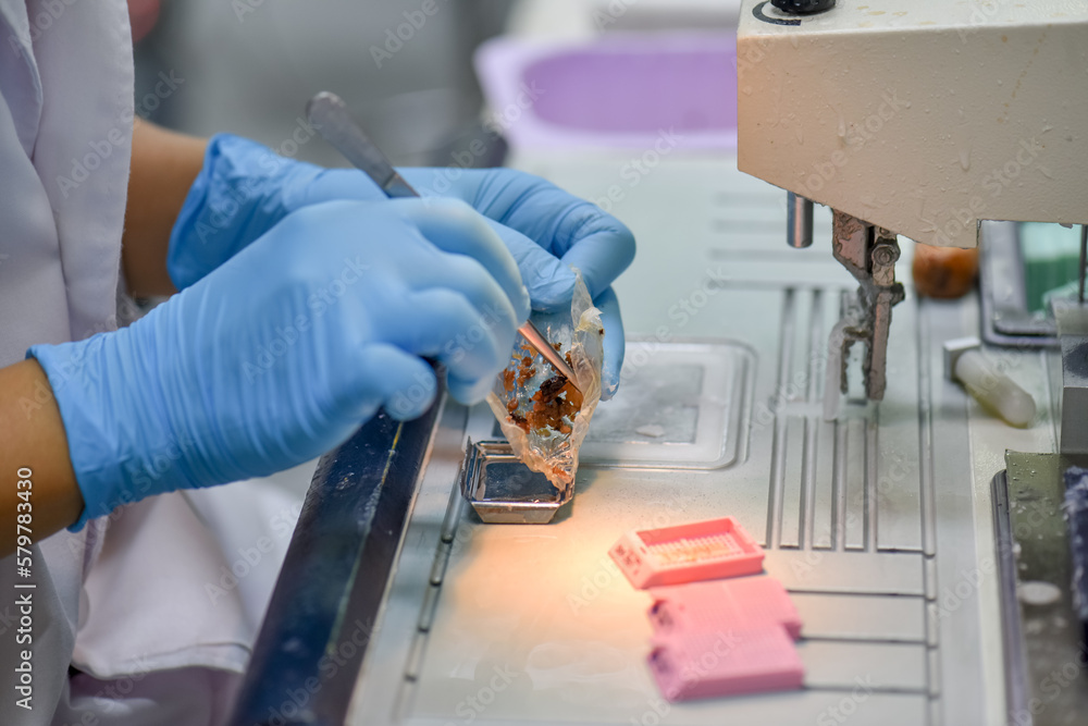 A pathologist is preparing a pathological biopsy for laboratory ...