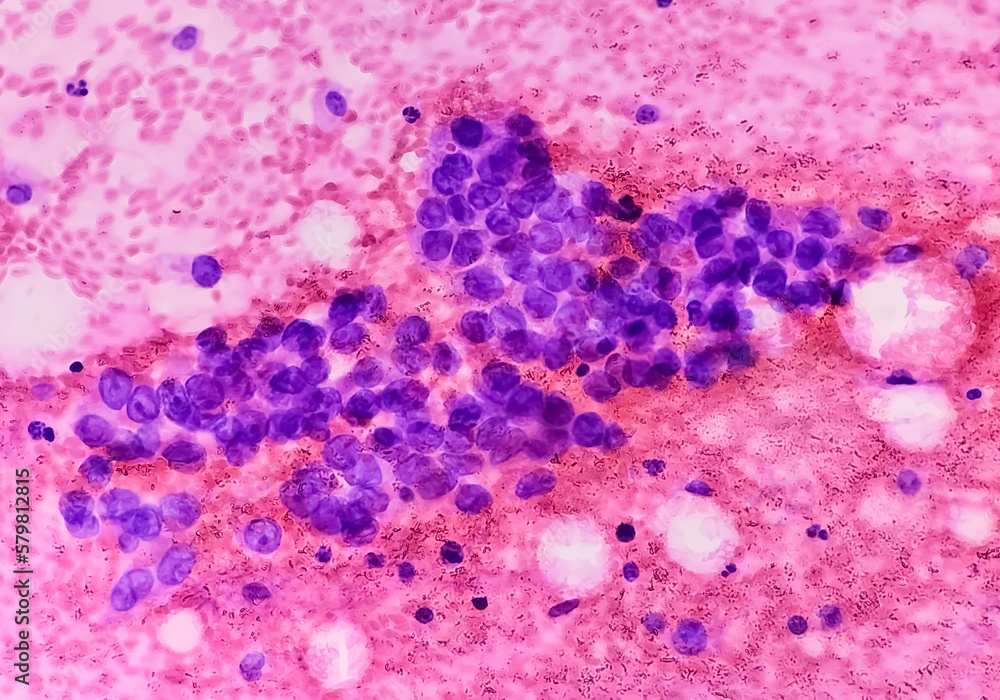Photomicrograph of fine needle aspiration (FNA) cytology of a pulmonary ...