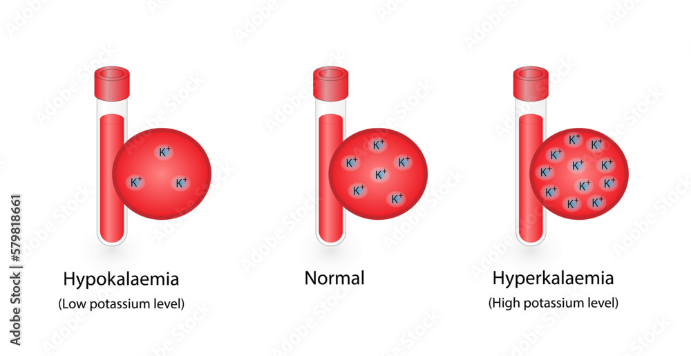 Vetor de Hyperkalaemia, high plasma potassium level and Hypokalaemia ...