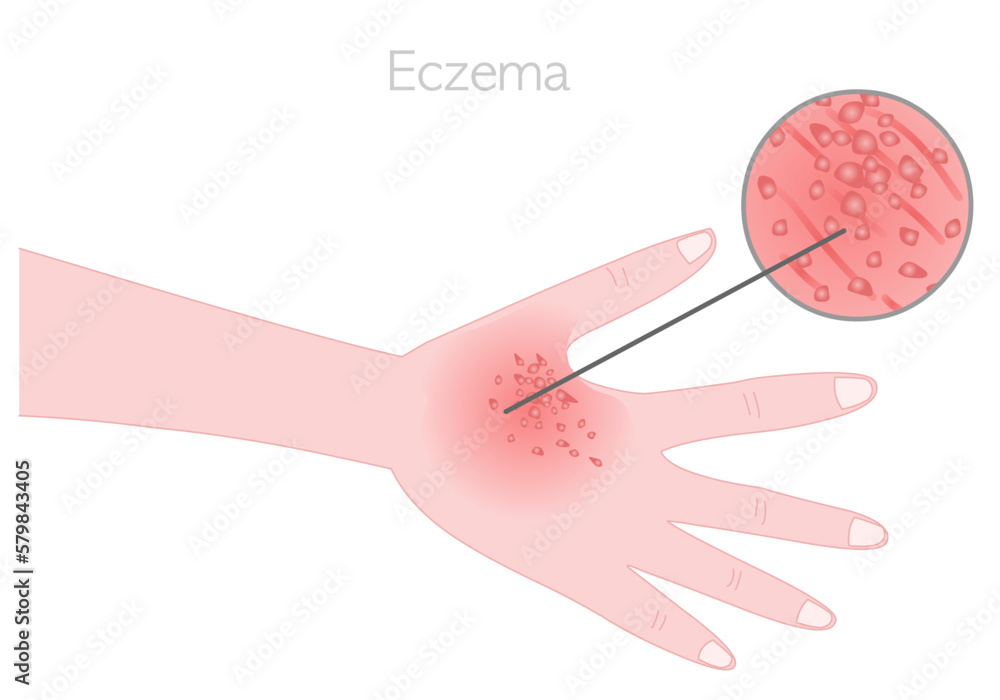 Eczema, atopic dermatitis. Itchiness, redness, rash on hand, feet ...