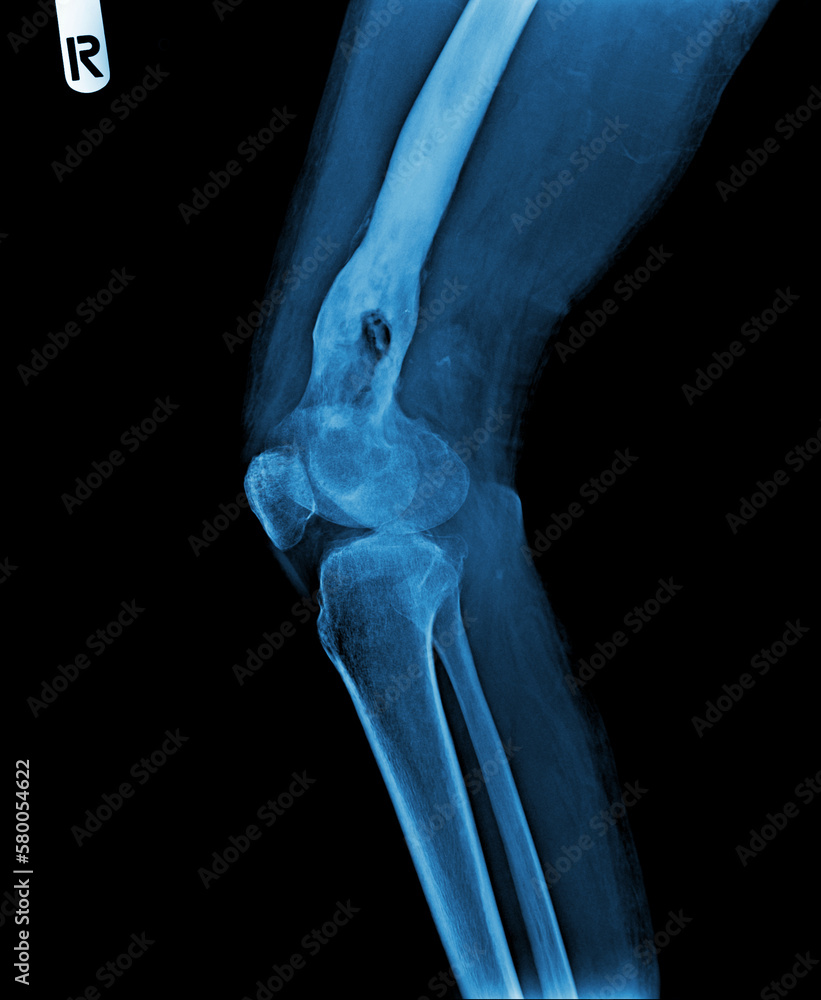Knee Osteoarthritis. Film x-ray of osteoarthritis knee patient and ...