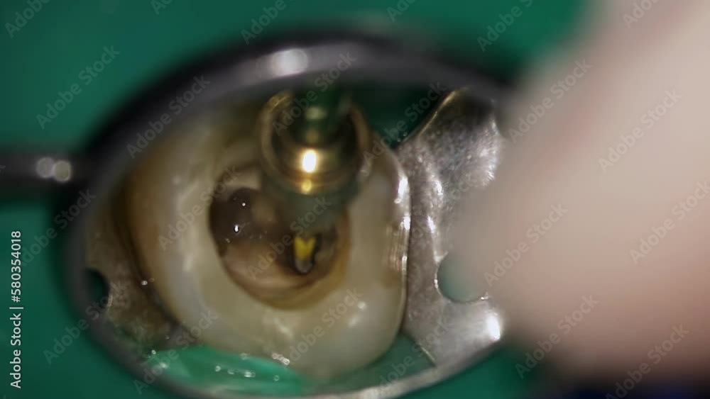 Dentist treats decay molar with medical drill and fills hole with water ...