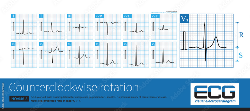 Counterclockwise rotation is a common ECG phenomenon, which is partly a ...