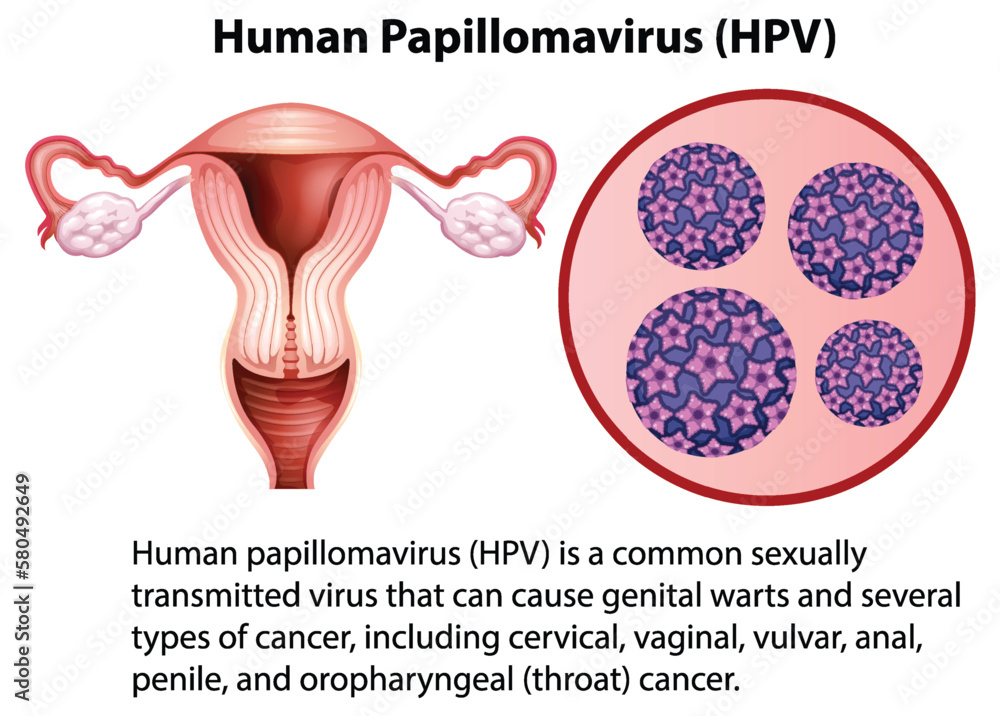 Human Papillomavirus with explanation Stock Vector | Adobe Stock