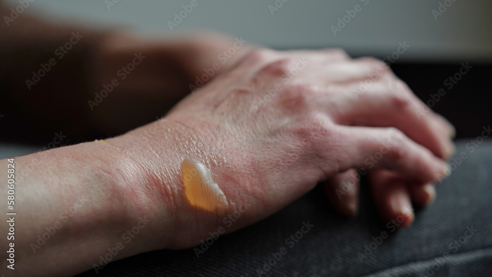 Close-up of a woman's hand with a blister from a boiled water burn ...