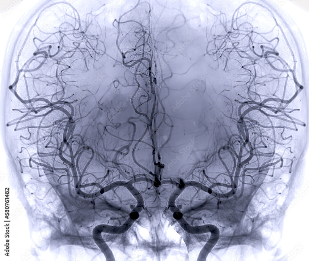 Cerebral angiography image from Fluoroscopy in intervention radiology ...