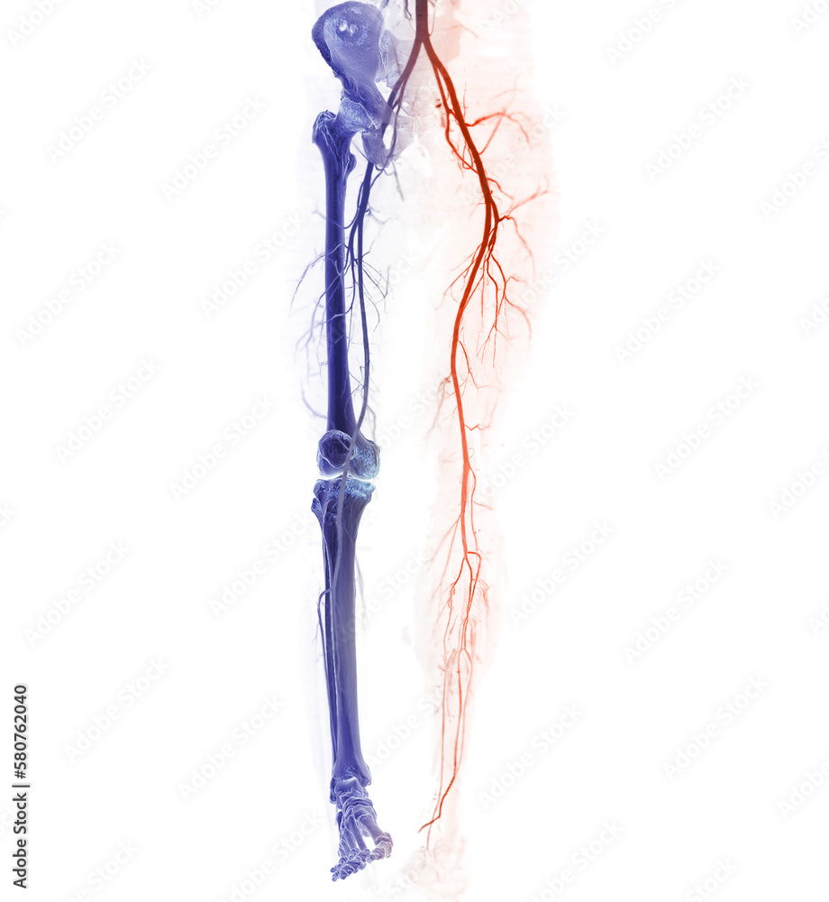 CTA femoral artery run off showing femoral artery for diagnostic Acute ...