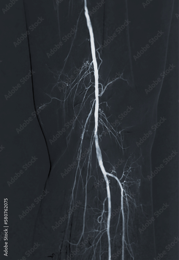 Femoral artery angiogram or angiography Stock Photo | Adobe Stock
