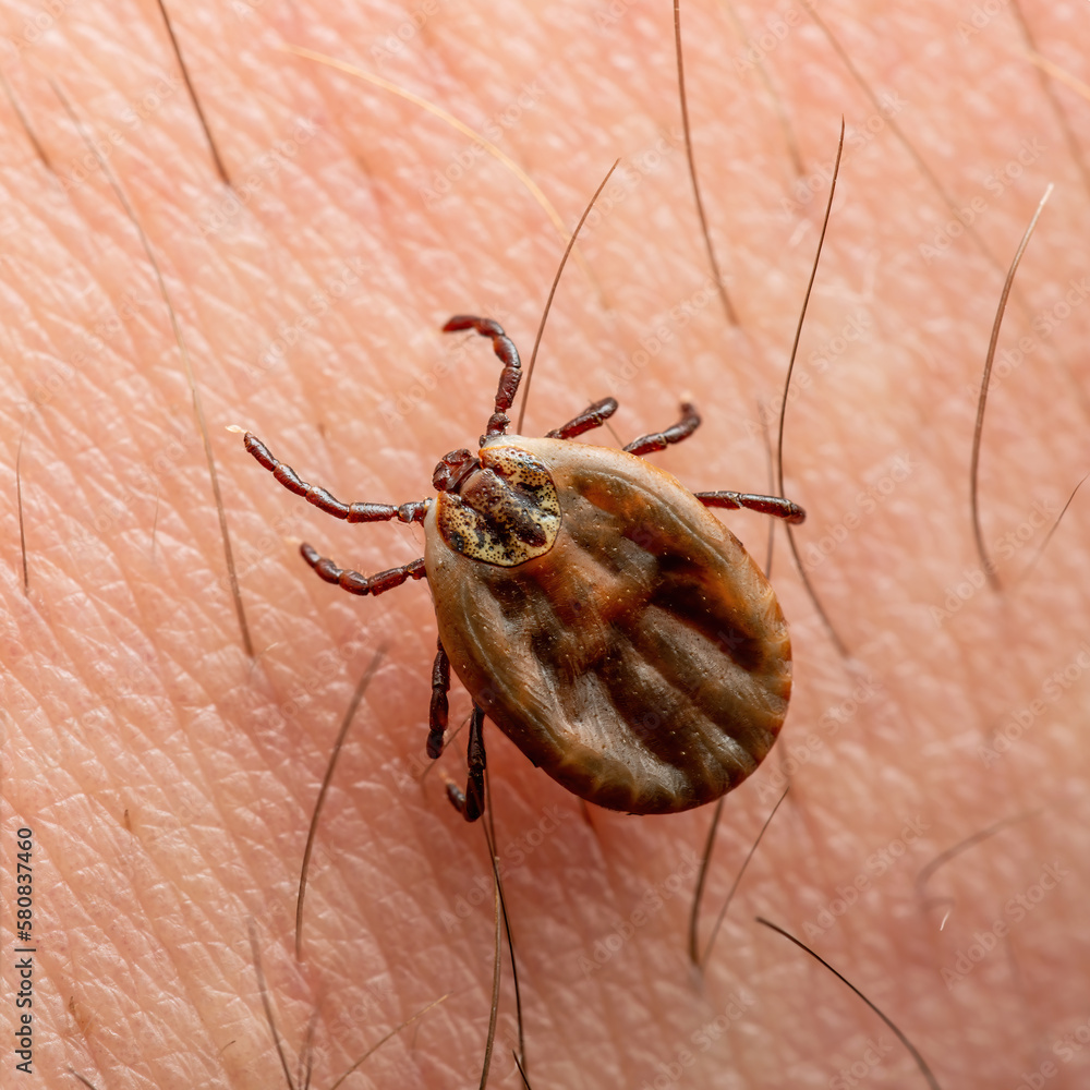 Infectious Encephalitis Tick Insect on Skin. Encephalitis Virus or Lyme ...