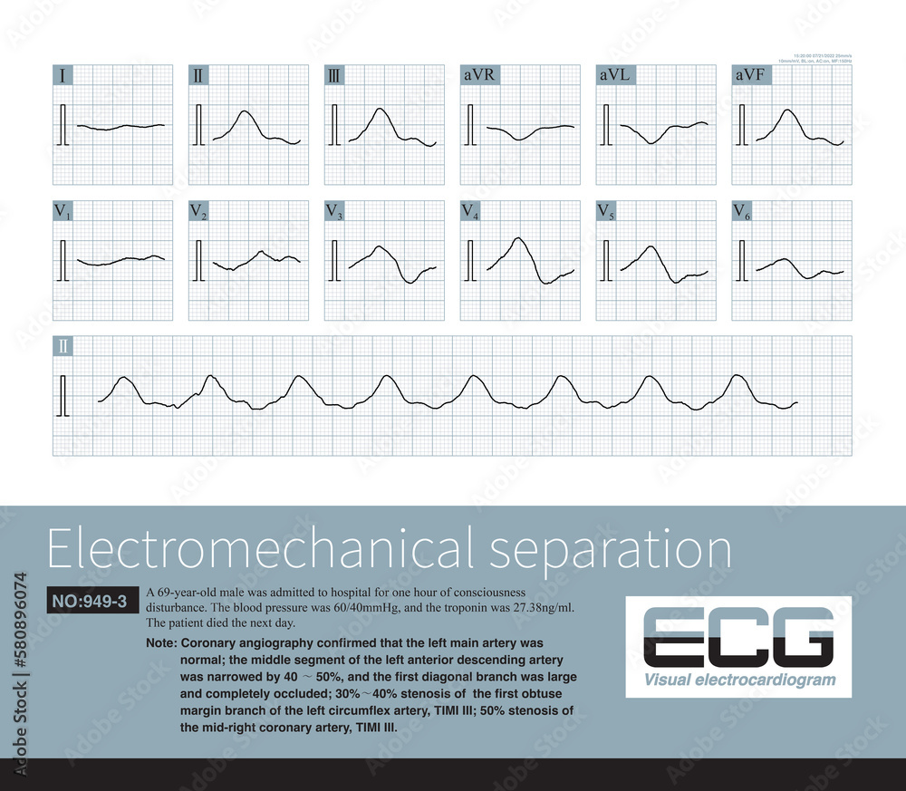 Electromechanical separation is a kind of terminal ECG. The patient's ...