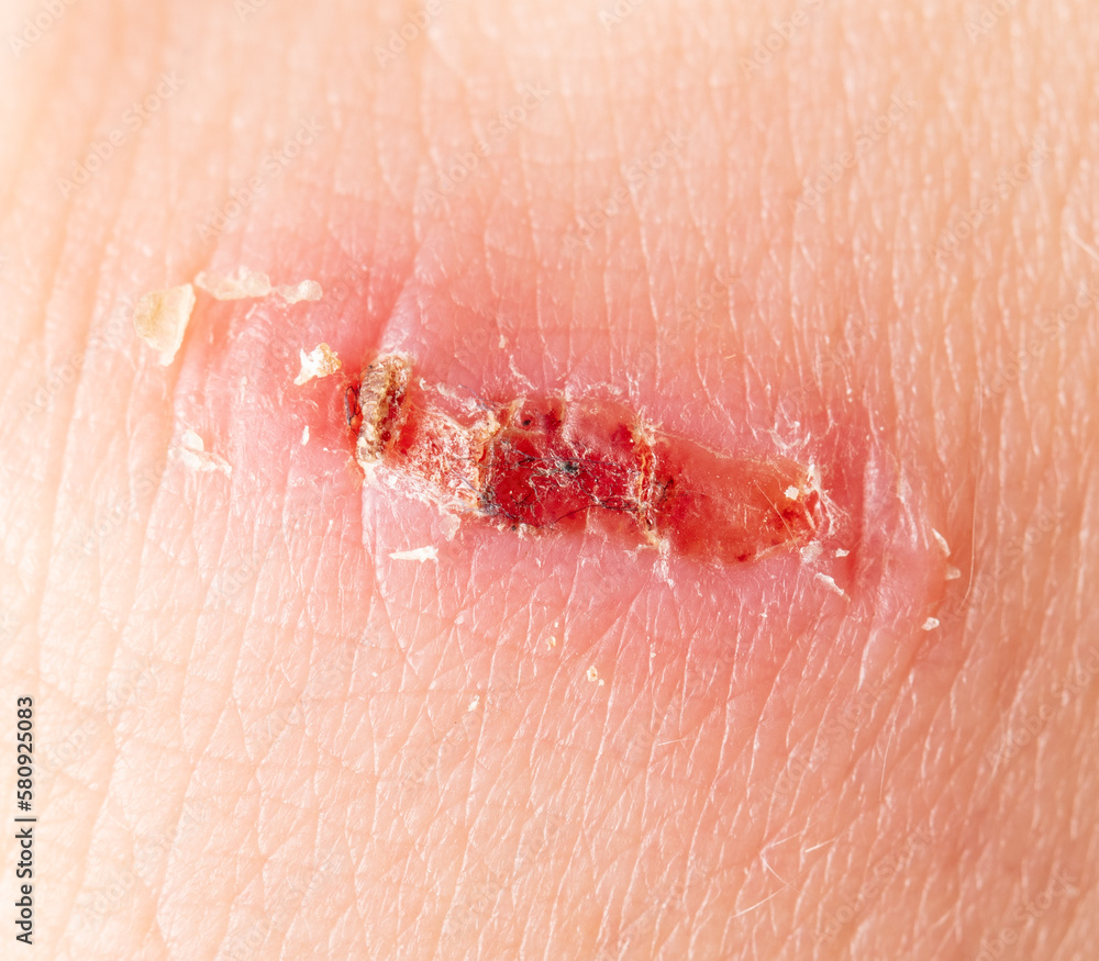 Wound on human skin. Macro Stock Photo | Adobe Stock