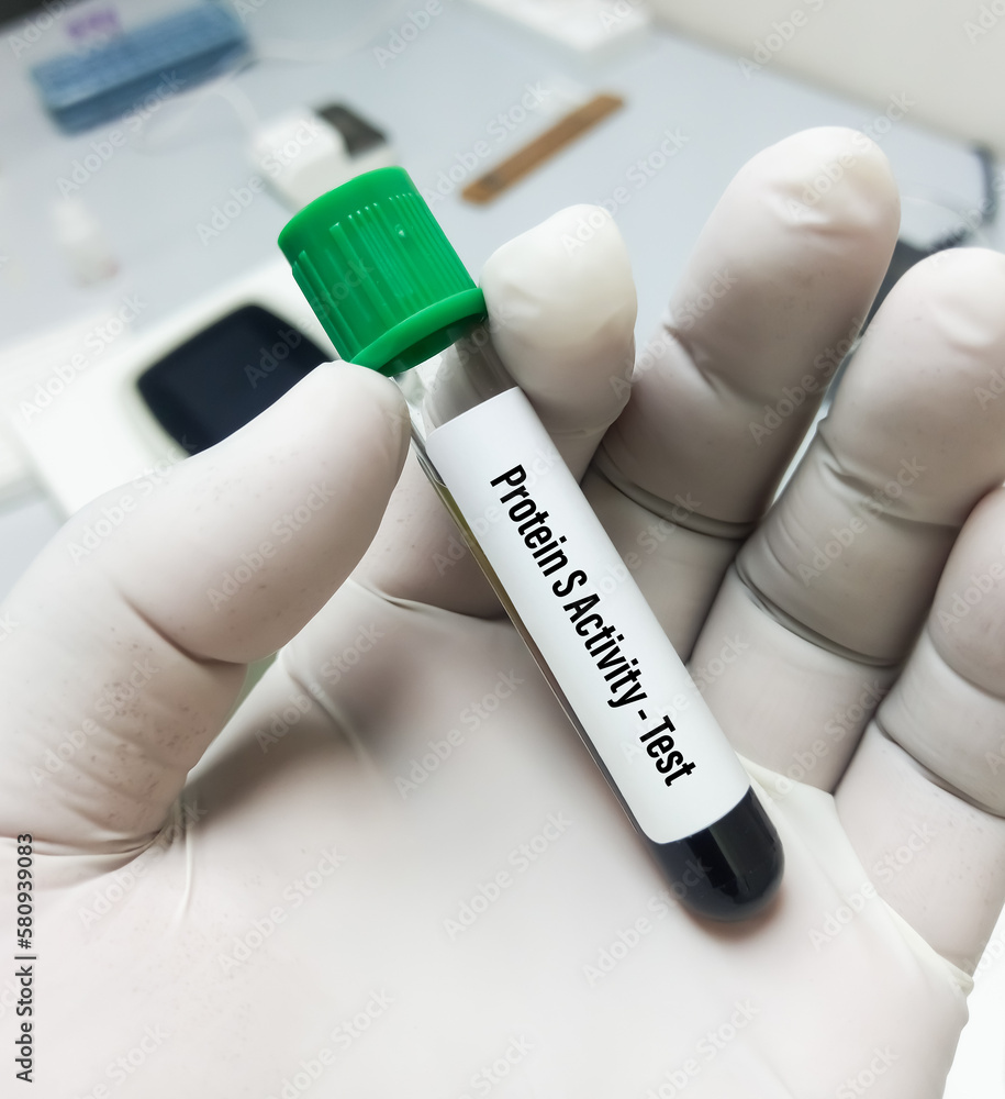 Blood sample for protein S activity test to diagnosis of coagulation ...