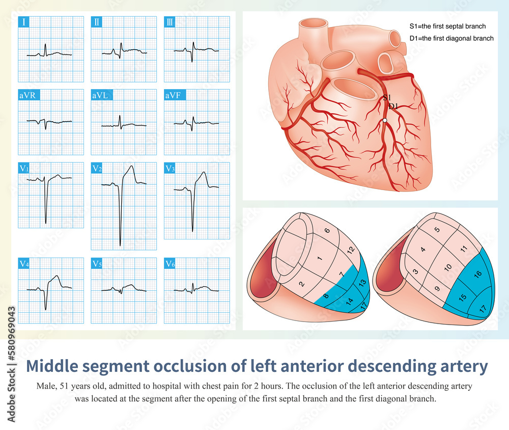 When the middle-distal segments of the LAD are occluded, the ECG of ...