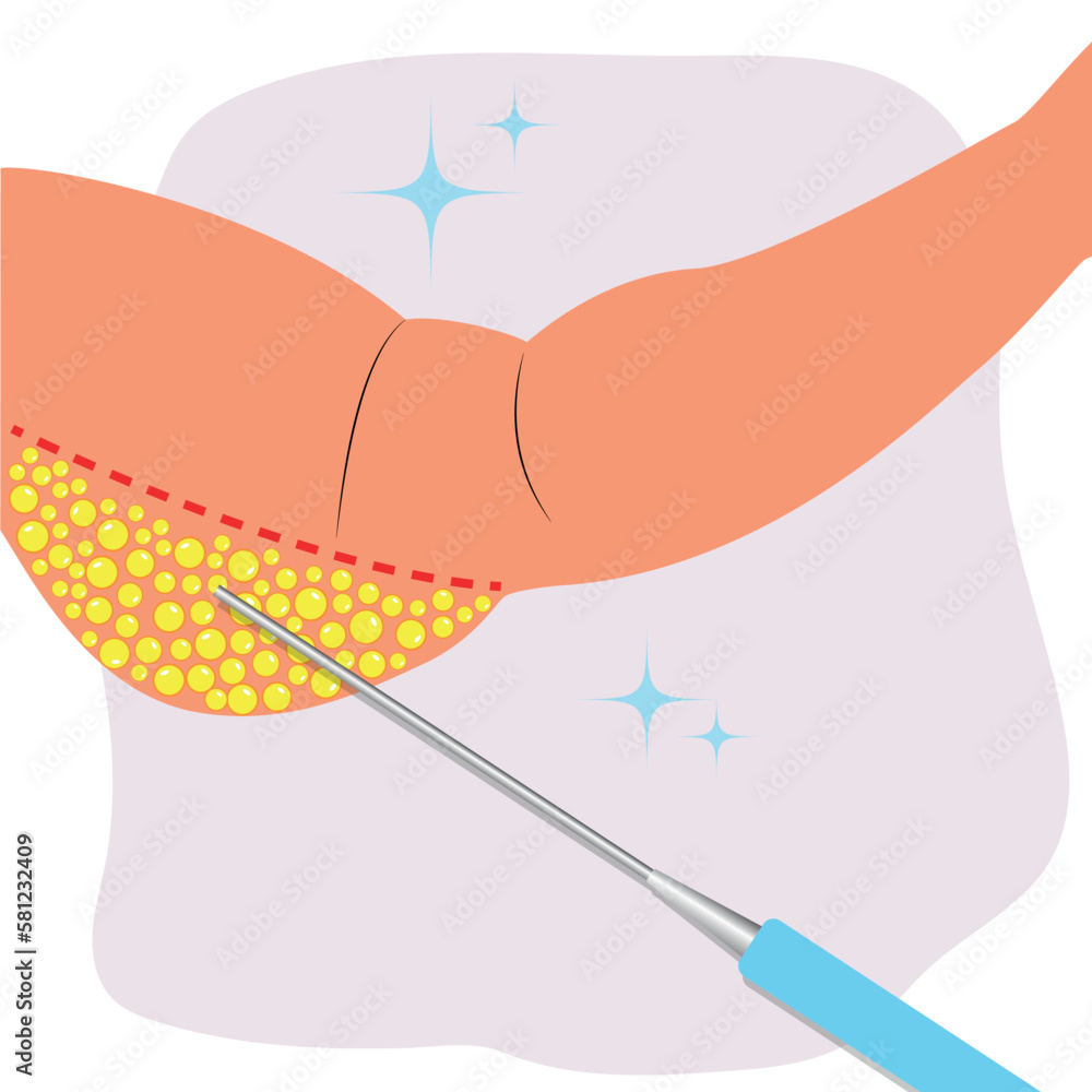 Fat arm of woman. Lipedema fat deposits. Liposuction concept Stock ...