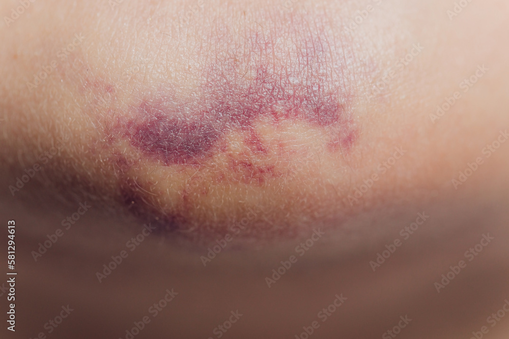 Laceration with stitches of the chin of a woman. Close up view, full ...