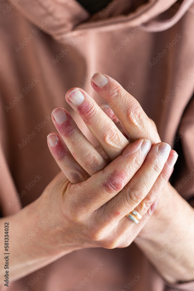 Woman hands with atopic dermatitis, eczema, allergy reaction on skin ...