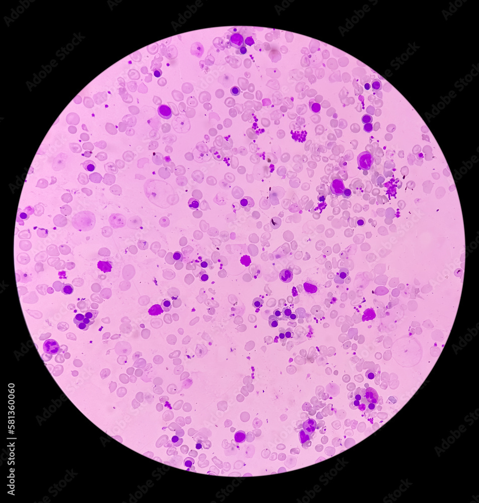 Hereditary hemolytic anemia. Hemoglobin E (HbE) disease. Smear show 90 ...