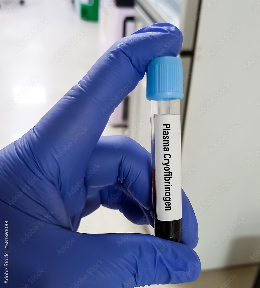 Scientist hold blood sample for Plasma Cryofibrinogen test, to ...