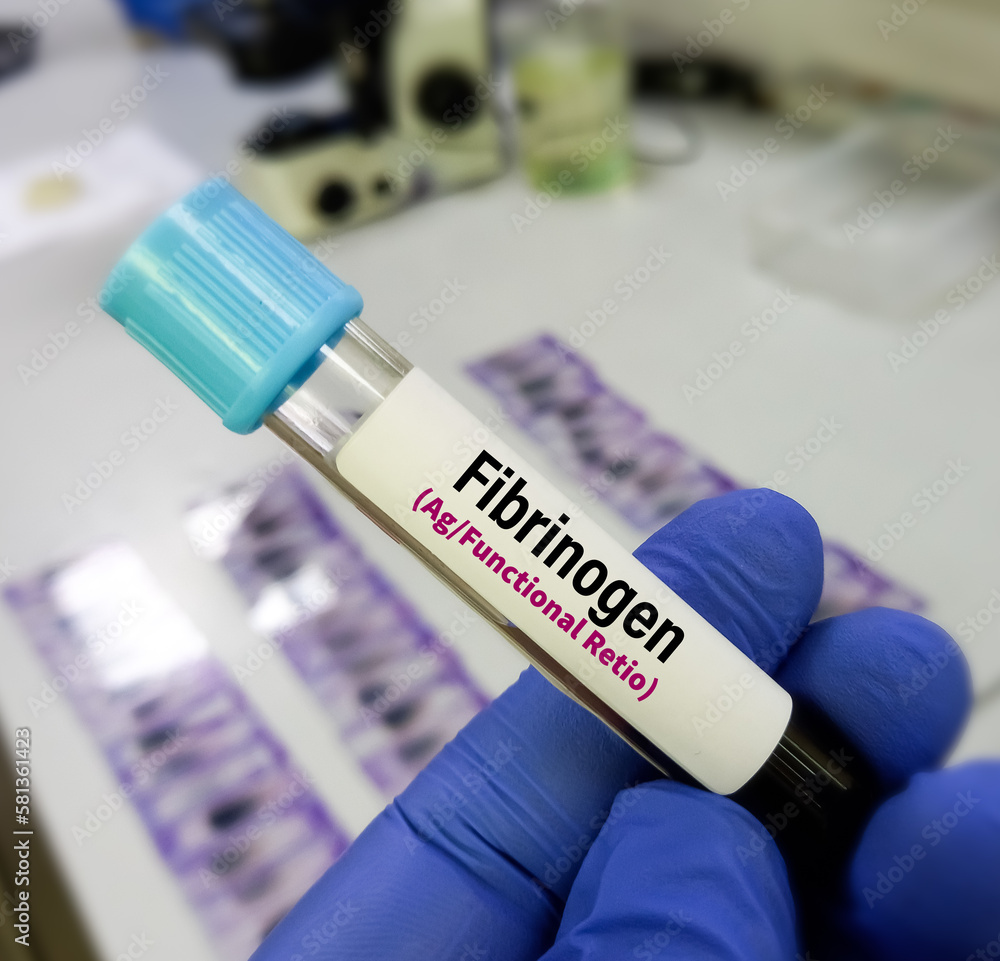 Technologist hold blood sample for fibrinogen Ag/Fungtional retio test ...
