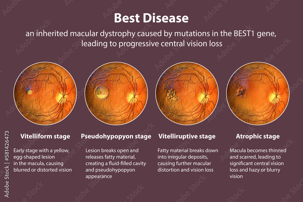 Vitelliform Macular Dystrophy