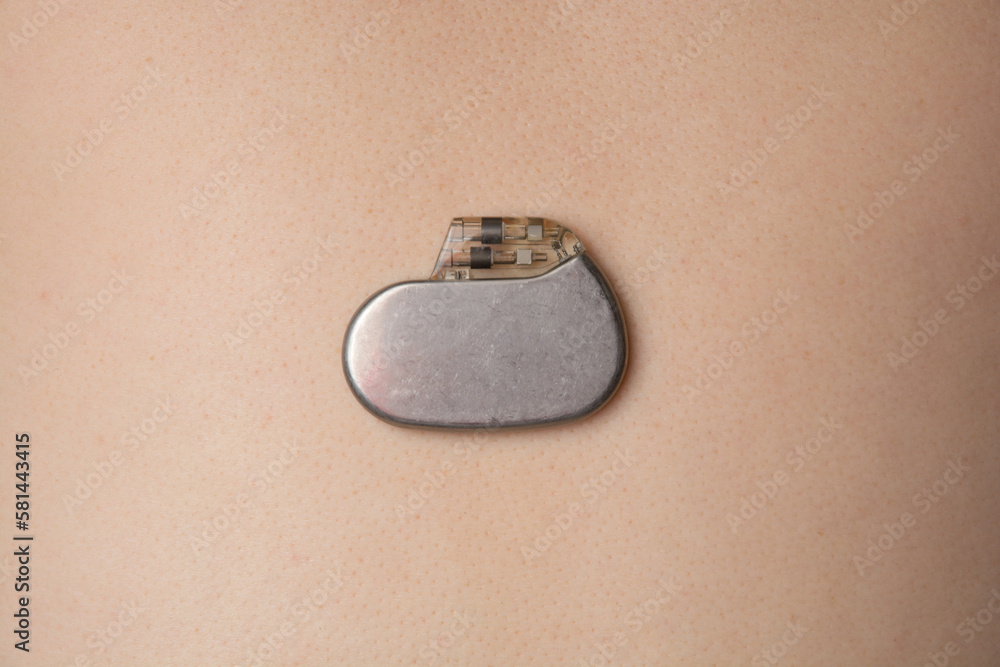 Poster pacemaker on the skin surface – Wall Art | UkPosters