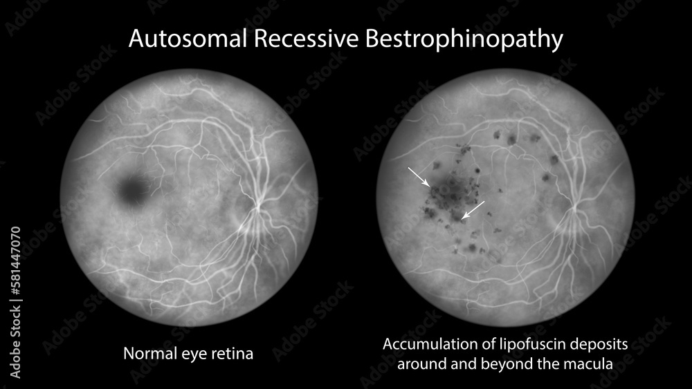 Autosomal recessive bestrophinopathy, illustration showing normal eye ...