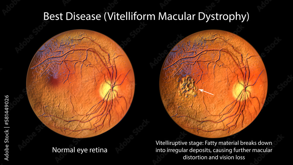 Best disease, 3D illustration showing normal eye retina and Best ...