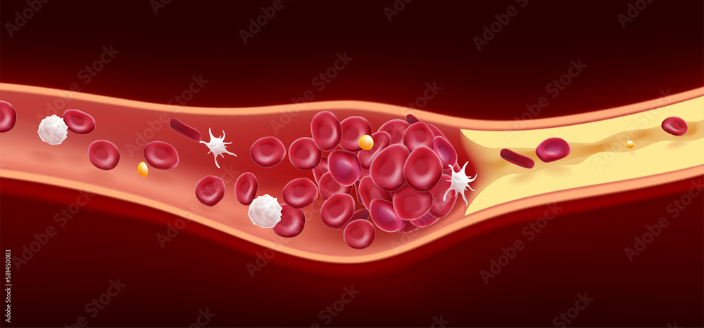 3D illustration of red blood cells and cholesterol clots cause death ...