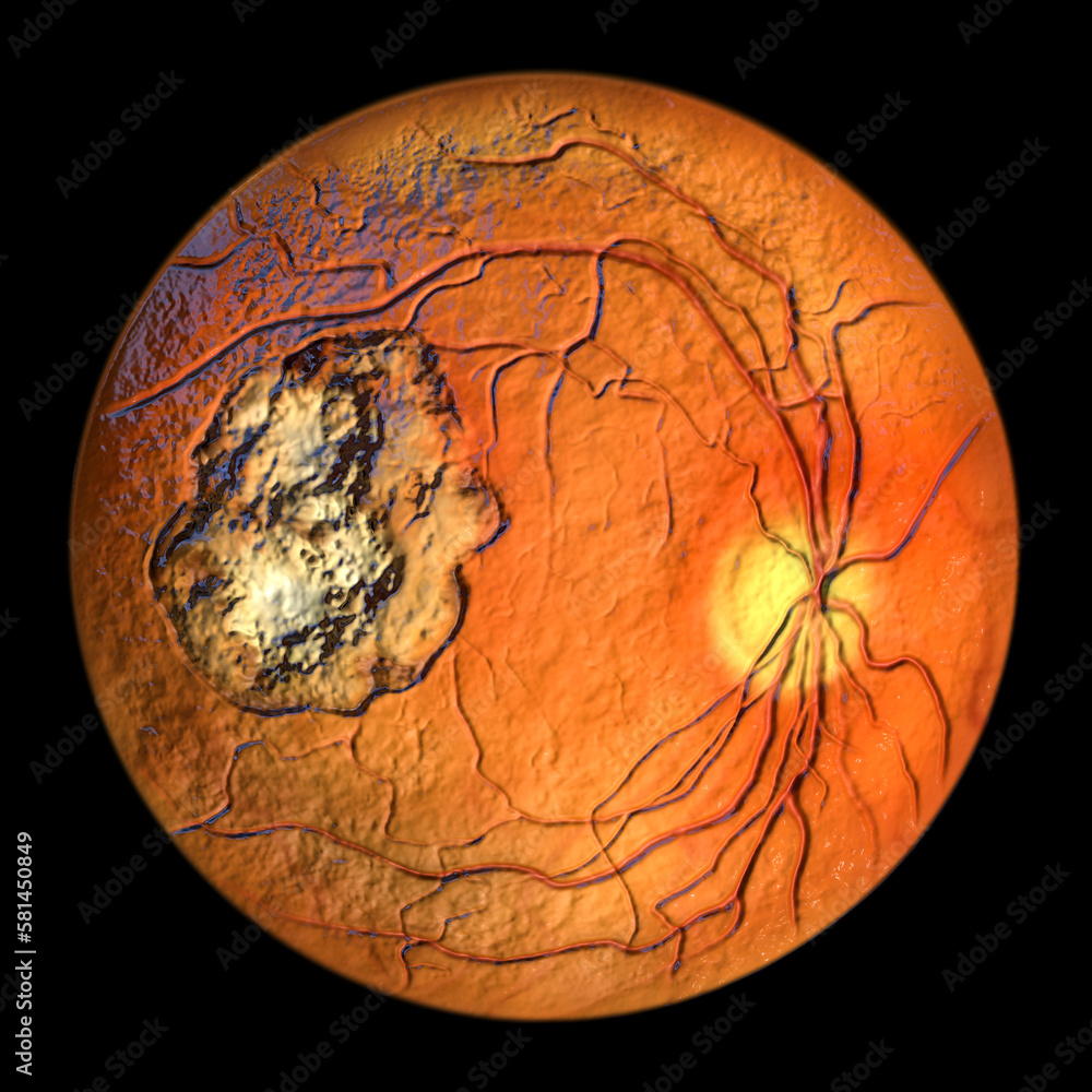 Retinal scar caused by a Toxoplasma gondii infection, or toxoplasmosis ...